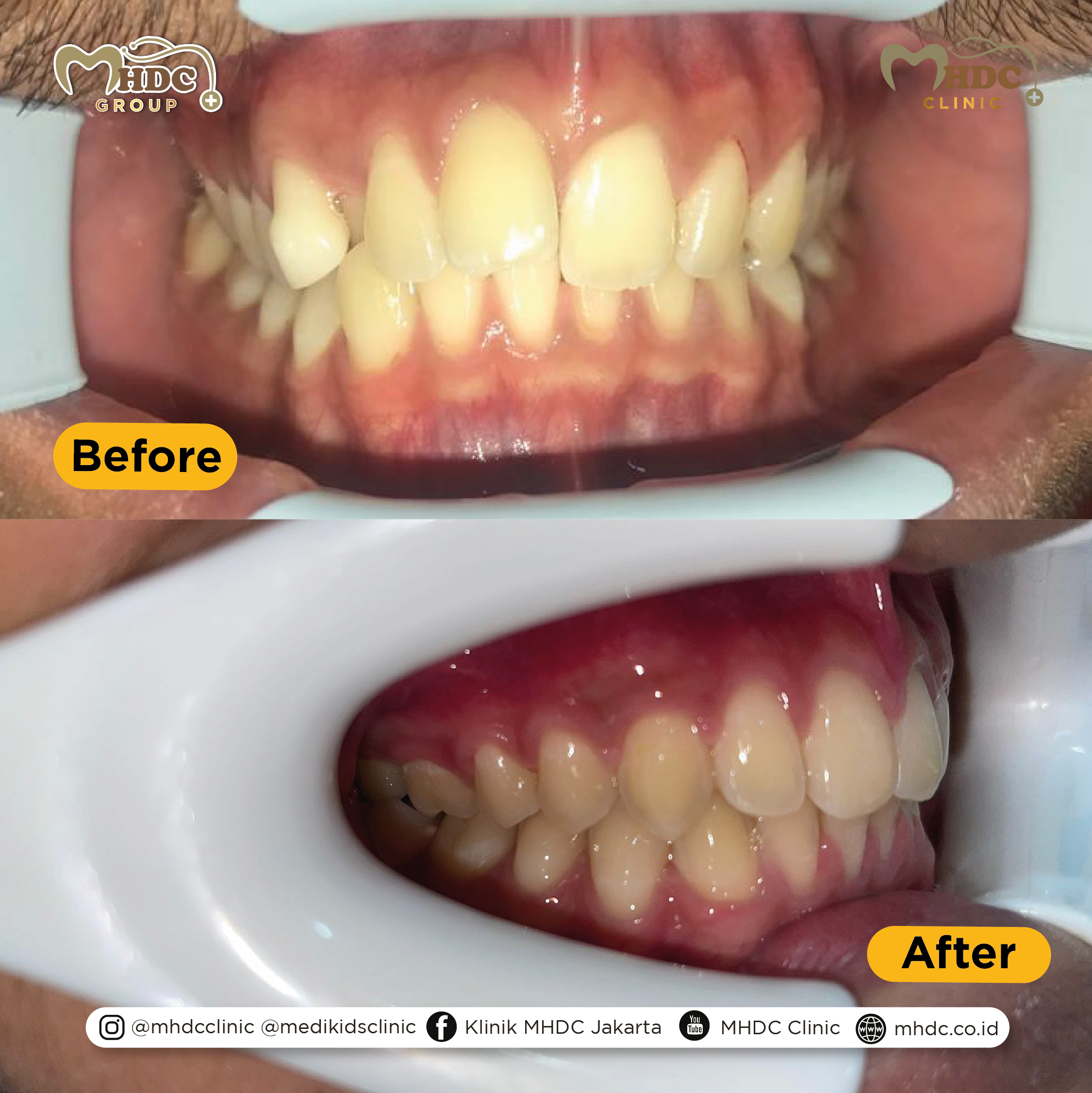 Behel Konvensional - MHDC Clinic