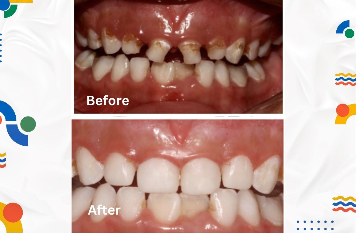 Penanganan Gigi Gigis/Hitam Pada Anak