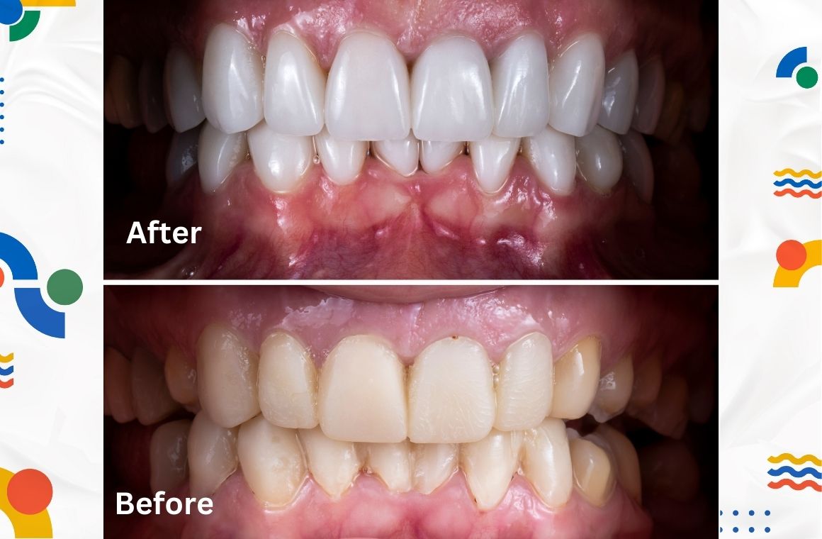 Klinik Veneer Gigi Terdekat & Terbaik di Jakarta