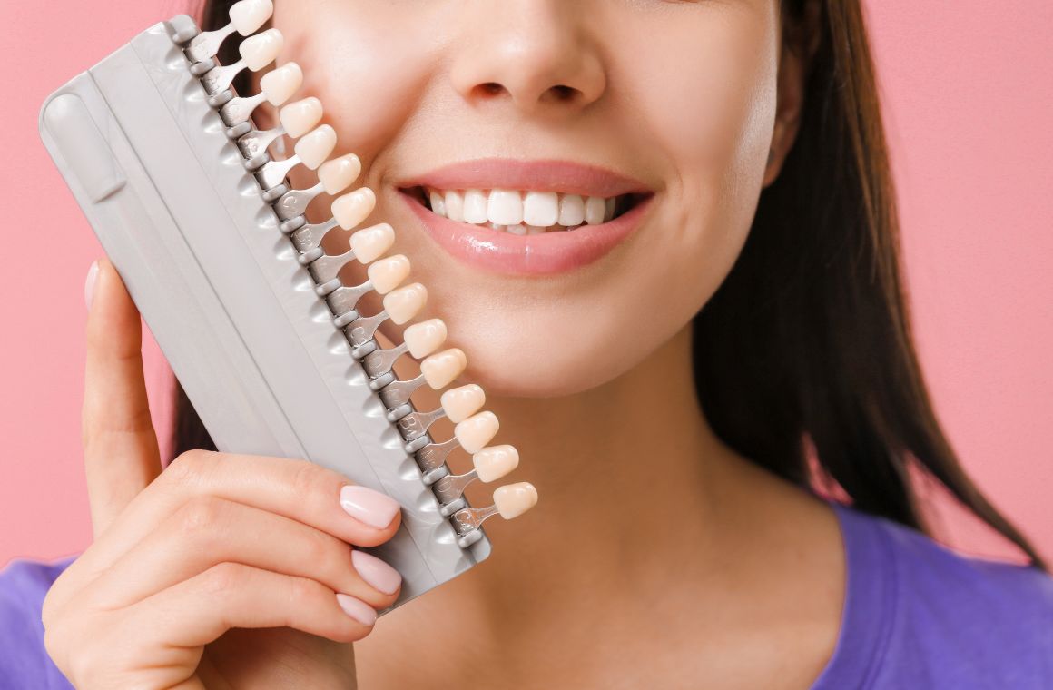 Veneer Gigi Adalah: Pengertian, Manfaat, dan Perawatannya