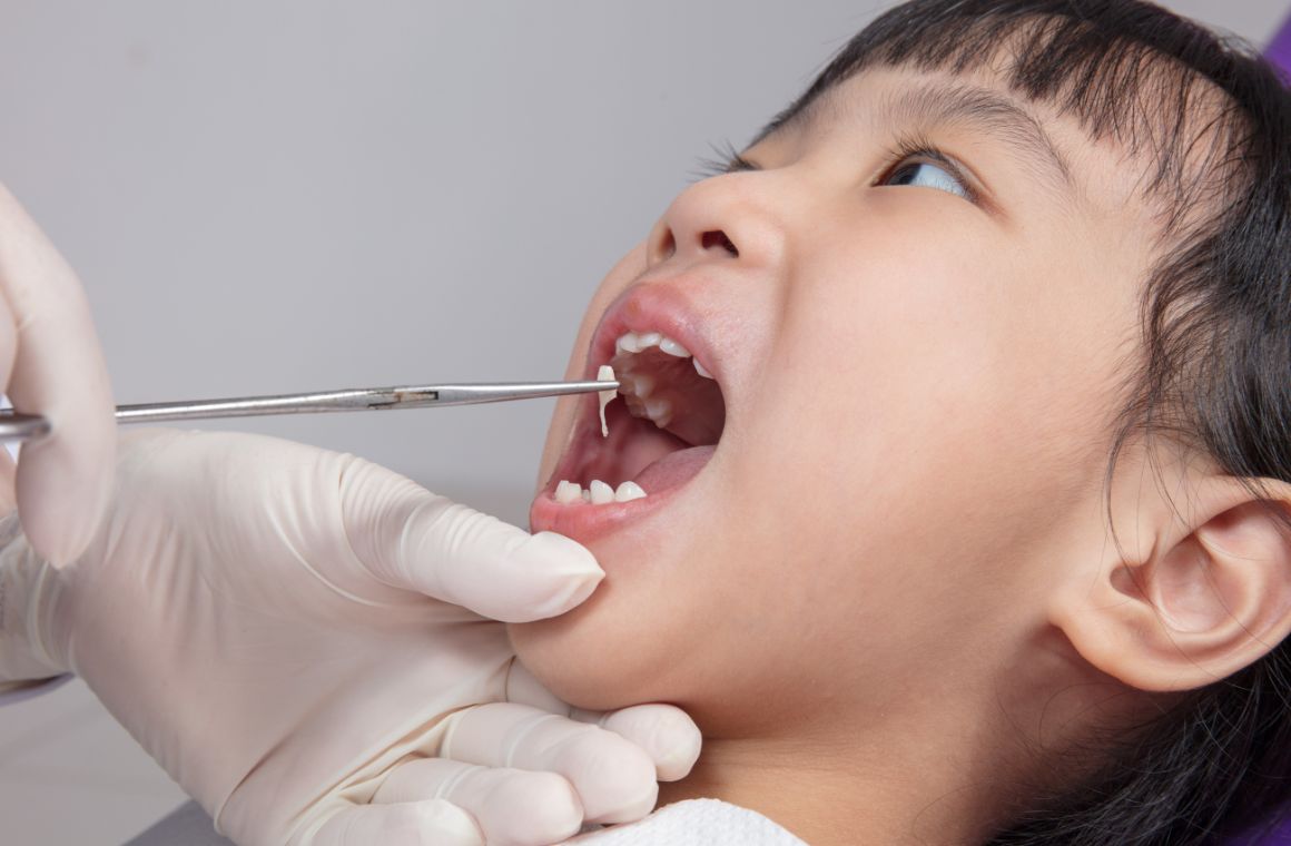 Cara Mencabut Gigi Anak dengan Aman MHDC - Dental Clinic