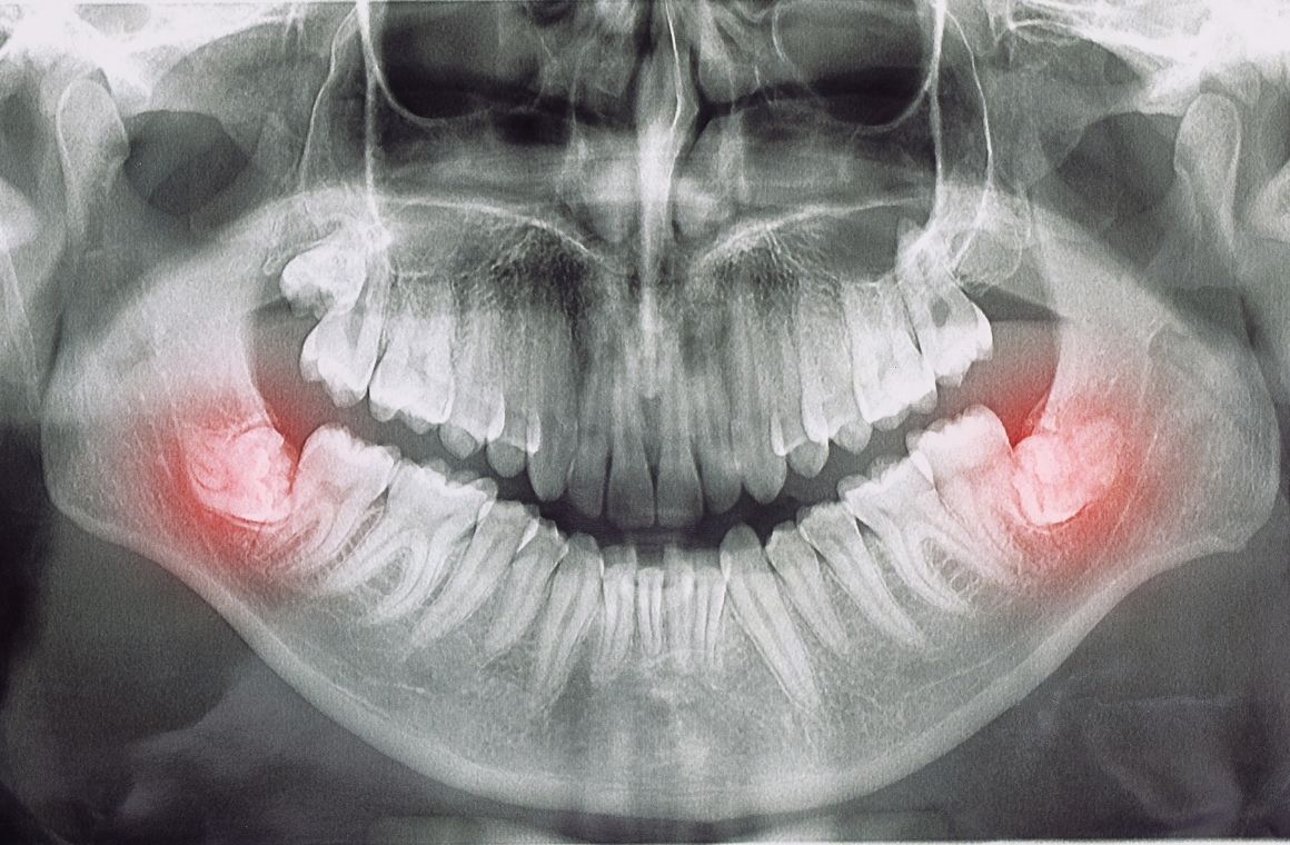 Operasi Cabut Gigi Geraham Bungsu