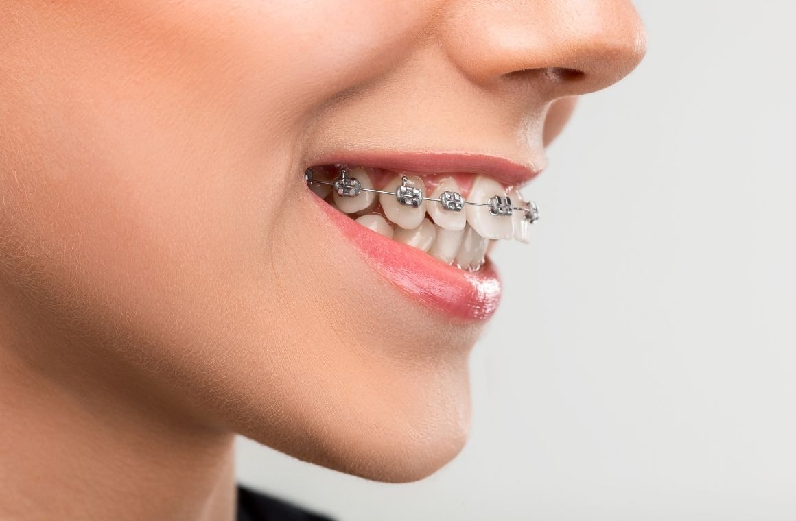 Behel Konvensional - MHDC Clinic