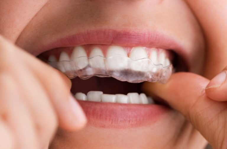 Behel Konvensional - MHDC Clinic