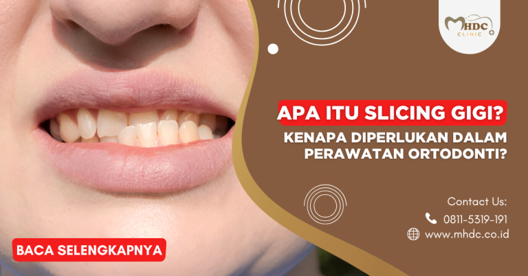 Apa Itu Slicing Gigi? Apa Manfaatnya dalam Perawatan Ortodonti?