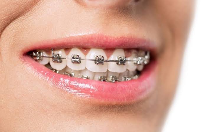 Tertarik Pasang Behel? Cek Dulu Jenis dan Harga Behel Gigi Berikut!