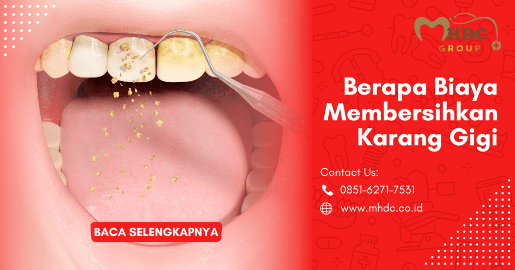 Biaya Membersihkan Karang Gigi Terbaru & Manfaatnya!