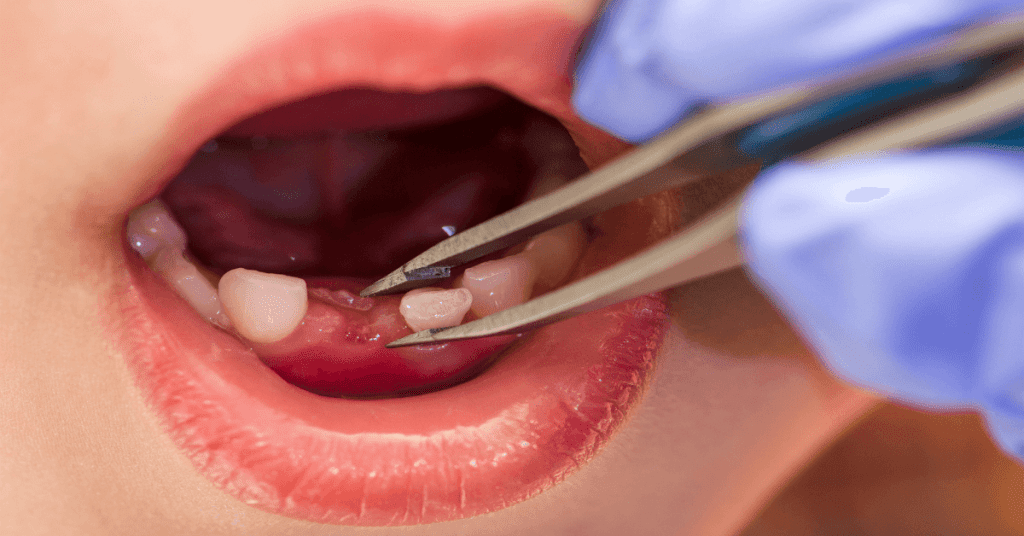 Cara Mencabut Gigi Anak dengan Aman dan Nyaman