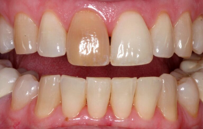 Cara Bleaching Gigi yang Dijamin Aman!