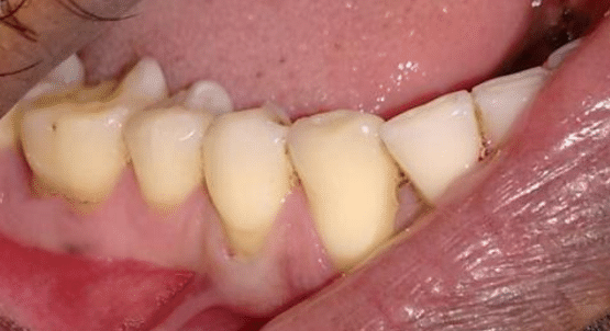 Gigi Terlihat Panjang Akibat Gusi Turun, Apakah Normal?