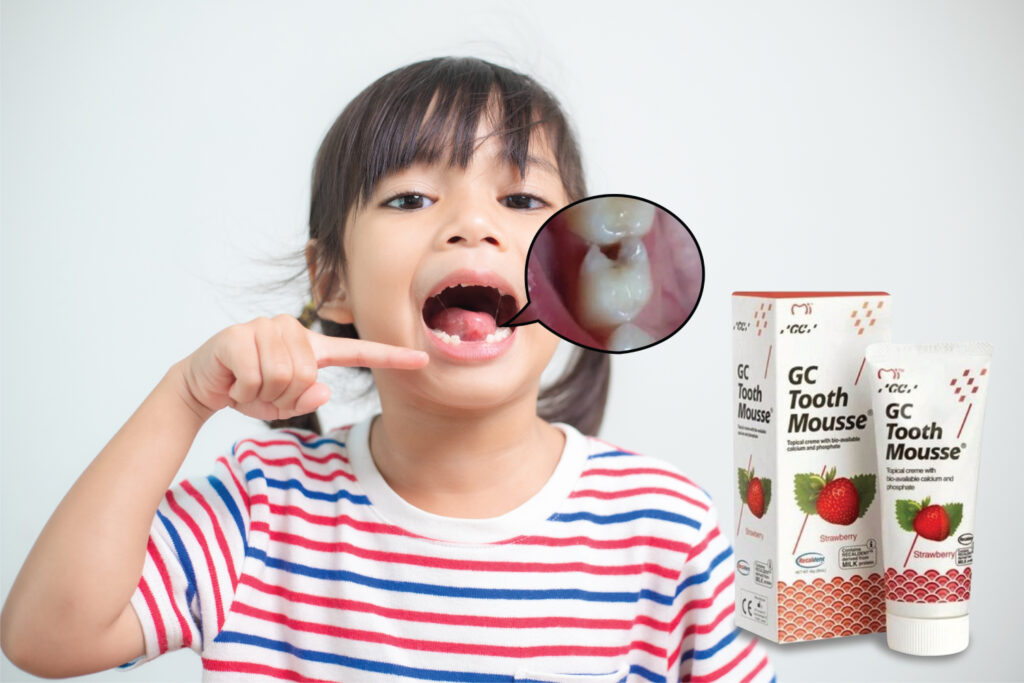 Fungsi Tooth Mousse Untuk Gigi Anak dan Cara Memakainya!