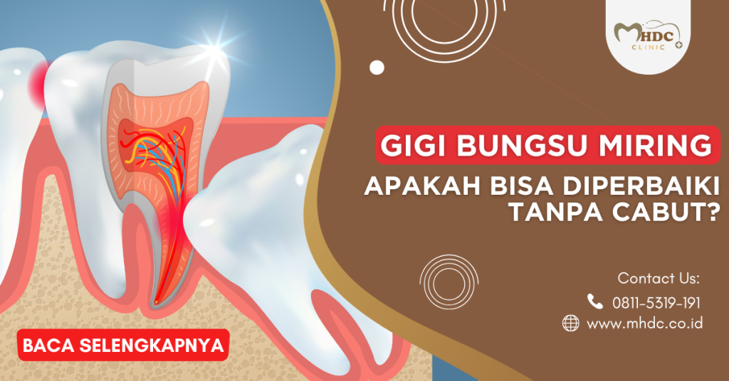 Gigi Bungsu Miring, Apakah Bisa Diperbaiki Tanpa Cabut?