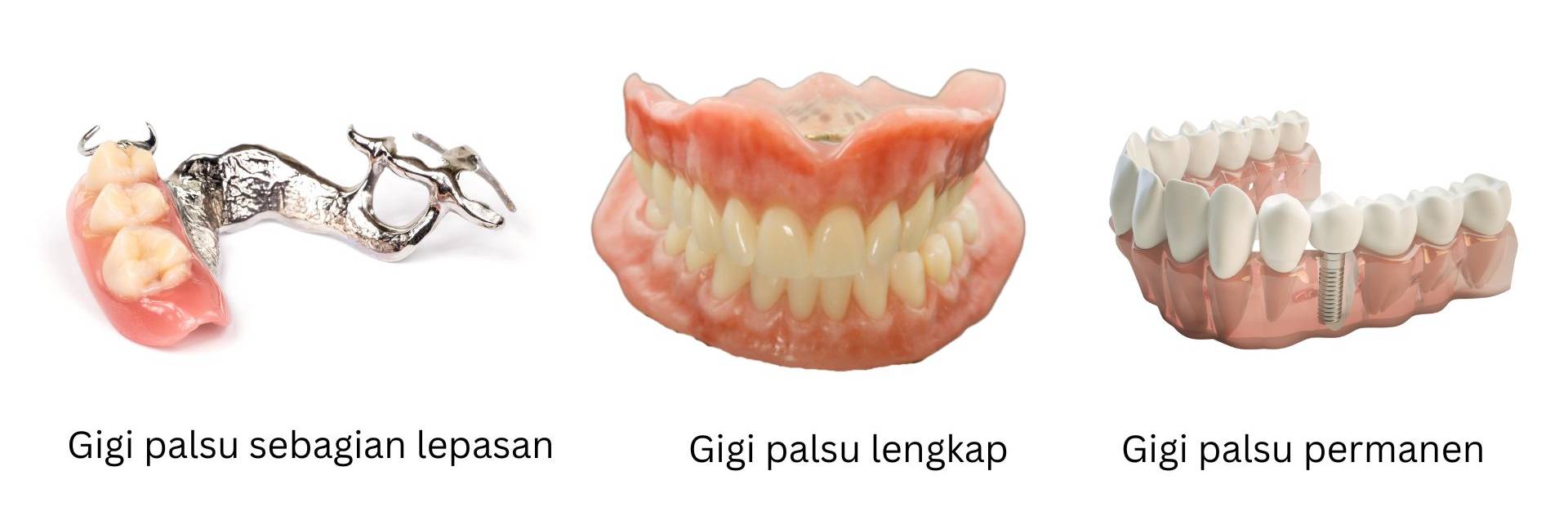 Sebelum Pasang Gigi Palsu, Ini yang Harus Kamu Tahu
