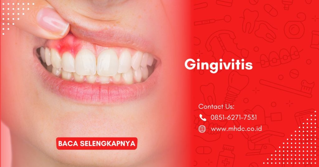 Gingivitis Adalah : Penyebab, Gejala dan Cara Pencegahannya!