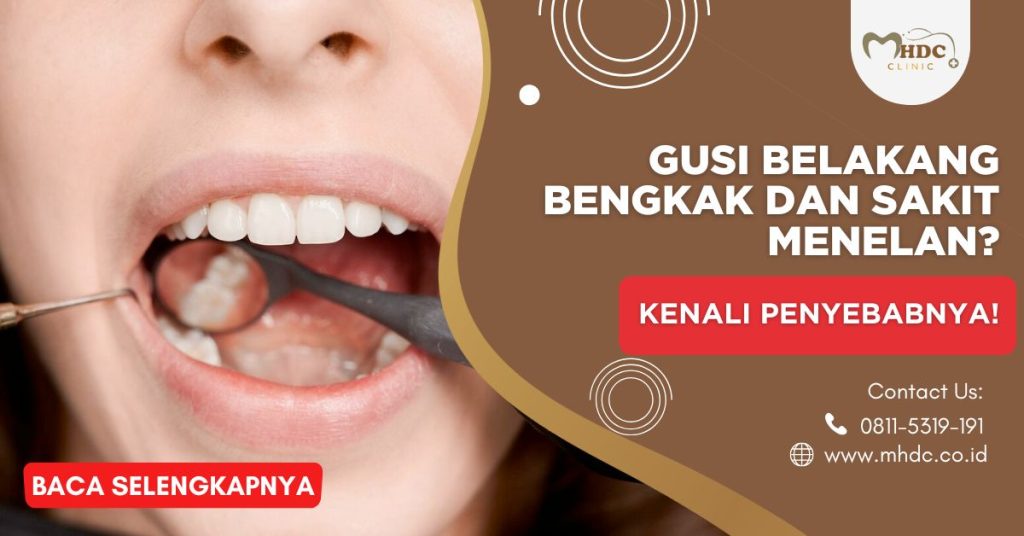 Gusi Belakang Bengkak dan Sakit Menelan? Kenali Penyebabnya!