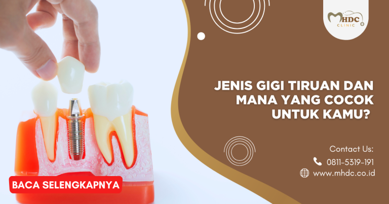 Jenis Gigi Tiruan dan Mana yang Cocok untuk Kamu?