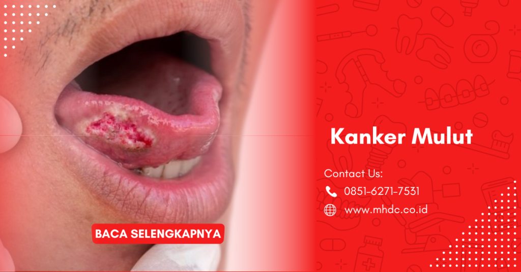 Gejala Awal Kanker Mulut