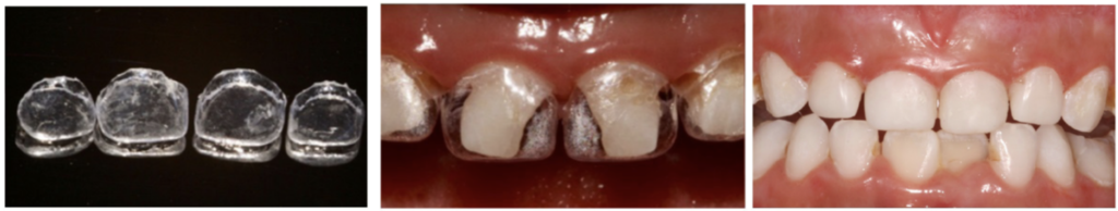 Perawatan Gigi Gigis Menggunakan Celluloid Crown