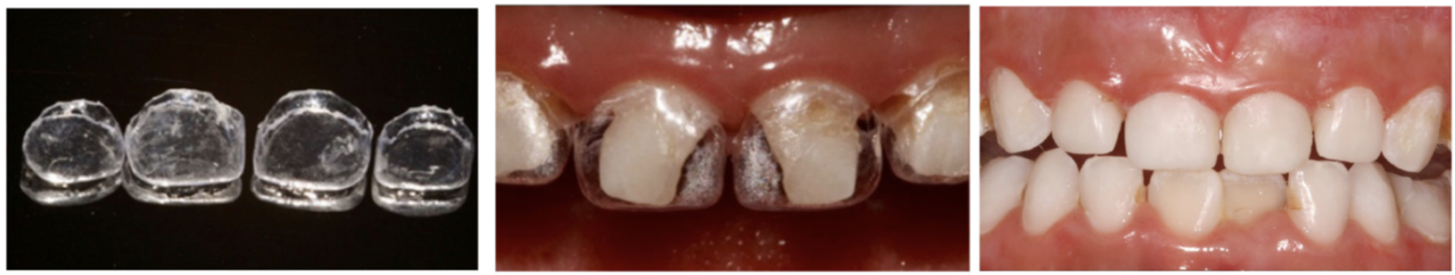 Perawatan Gigi Gigis Menggunakan Celluloid Crown