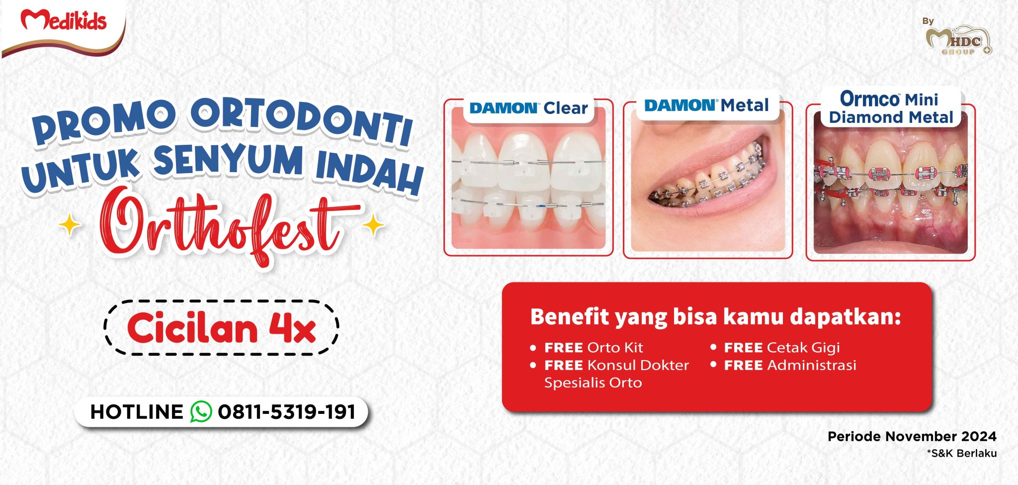 Tertarik Pasang Behel? Cek Dulu Jenis dan Harga Behel Gigi Berikut!
