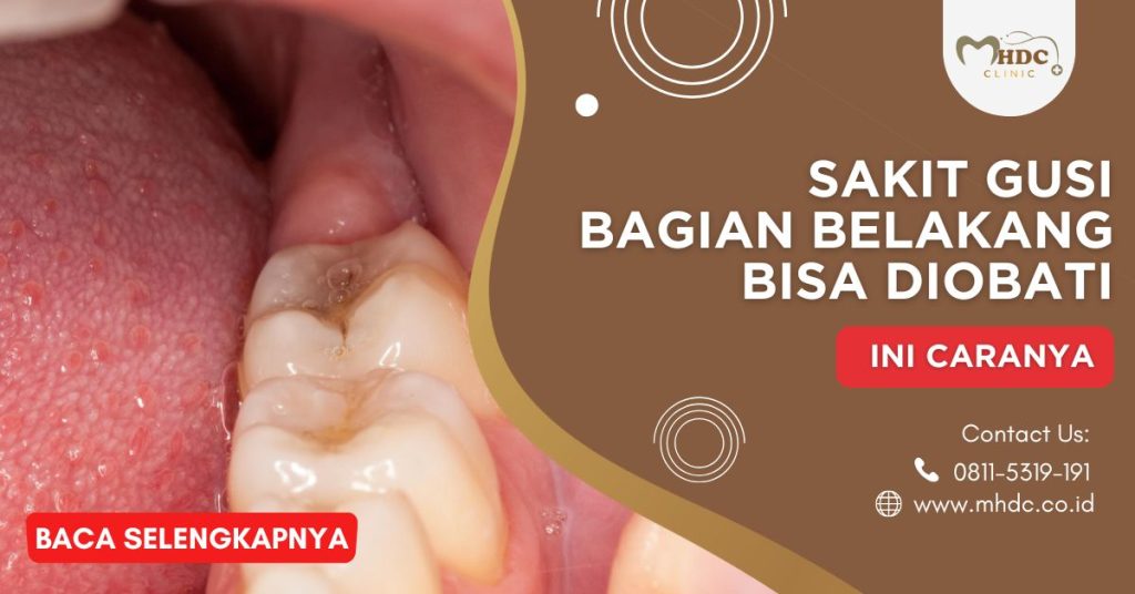 Sakit Gusi Bagian Belakang Bisa Diobati, Ini Caranya!