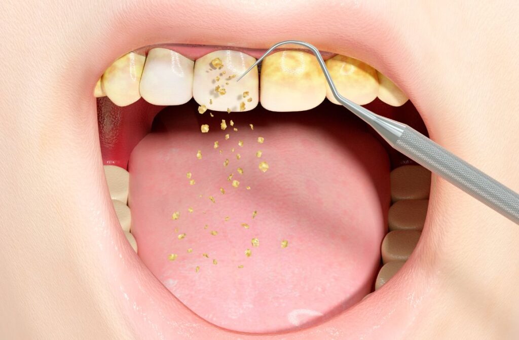 Scaling Gigi Adalah : Pengertian, Manfaat dan Prosedurnya!