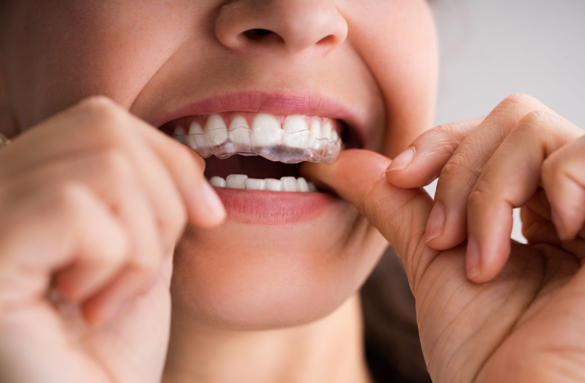 Clear Aligner Terdekat - MHDC Clinic