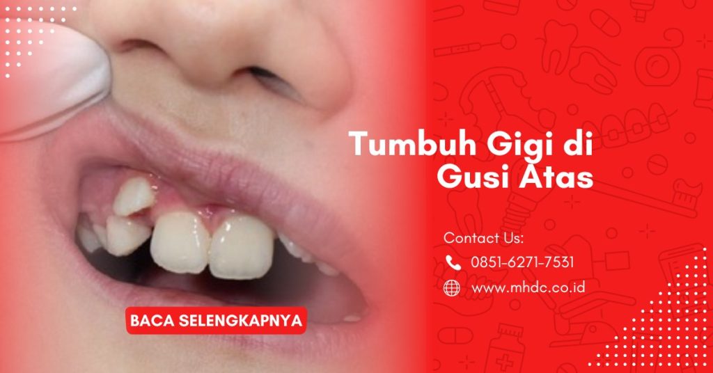 Proses Tumbuh Gigi di Gusi Atas pada Bayi dan Anak