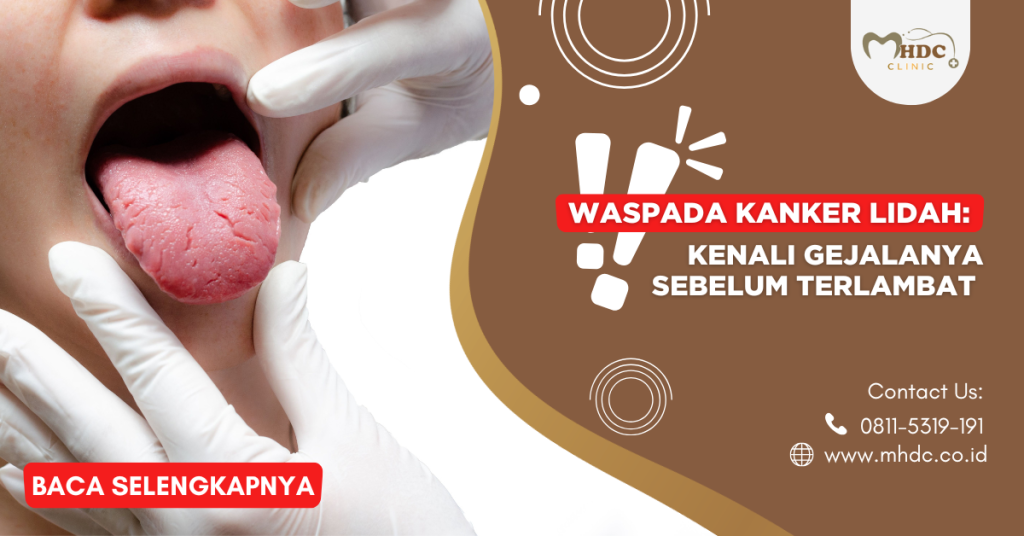 Waspada Kanker Lidah: Kenali Gejalanya Sebelum Terlambat