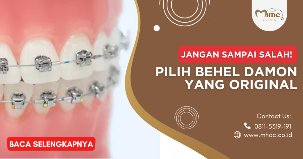 Jangan Sampai Salah! Pilih Behel Damon yang Original