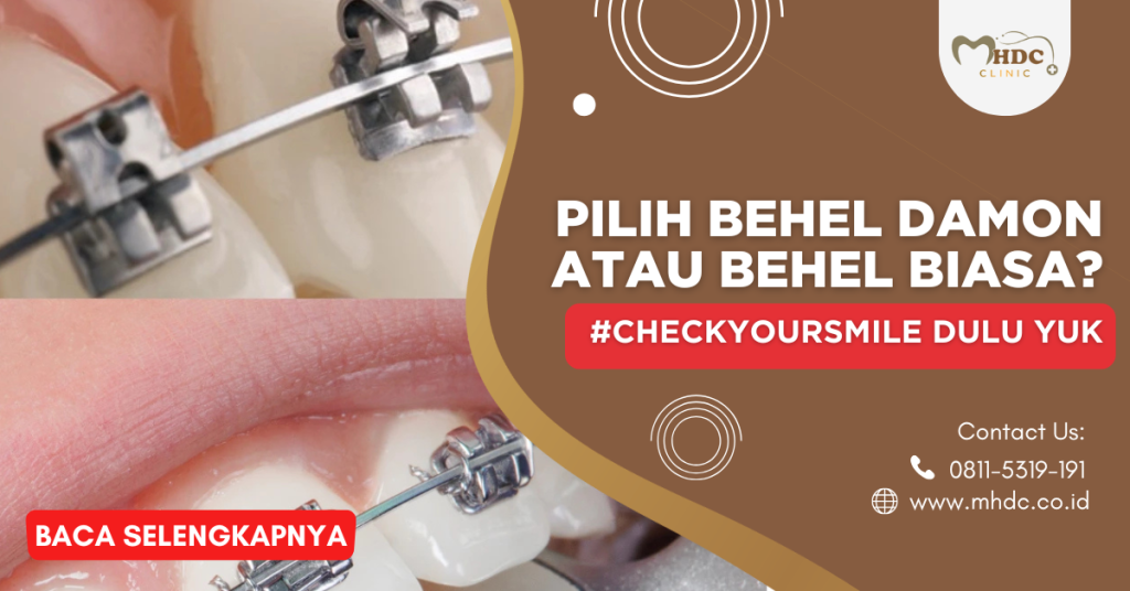 Pilih Behel Damon atau Behel Biasa? #CheckYourSmile Dulu Yuk!