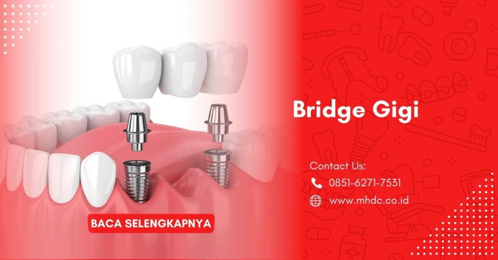 Apa Itu Bridge Gigi? Pengertian, Fungsi, Jenis dan Perawatannya