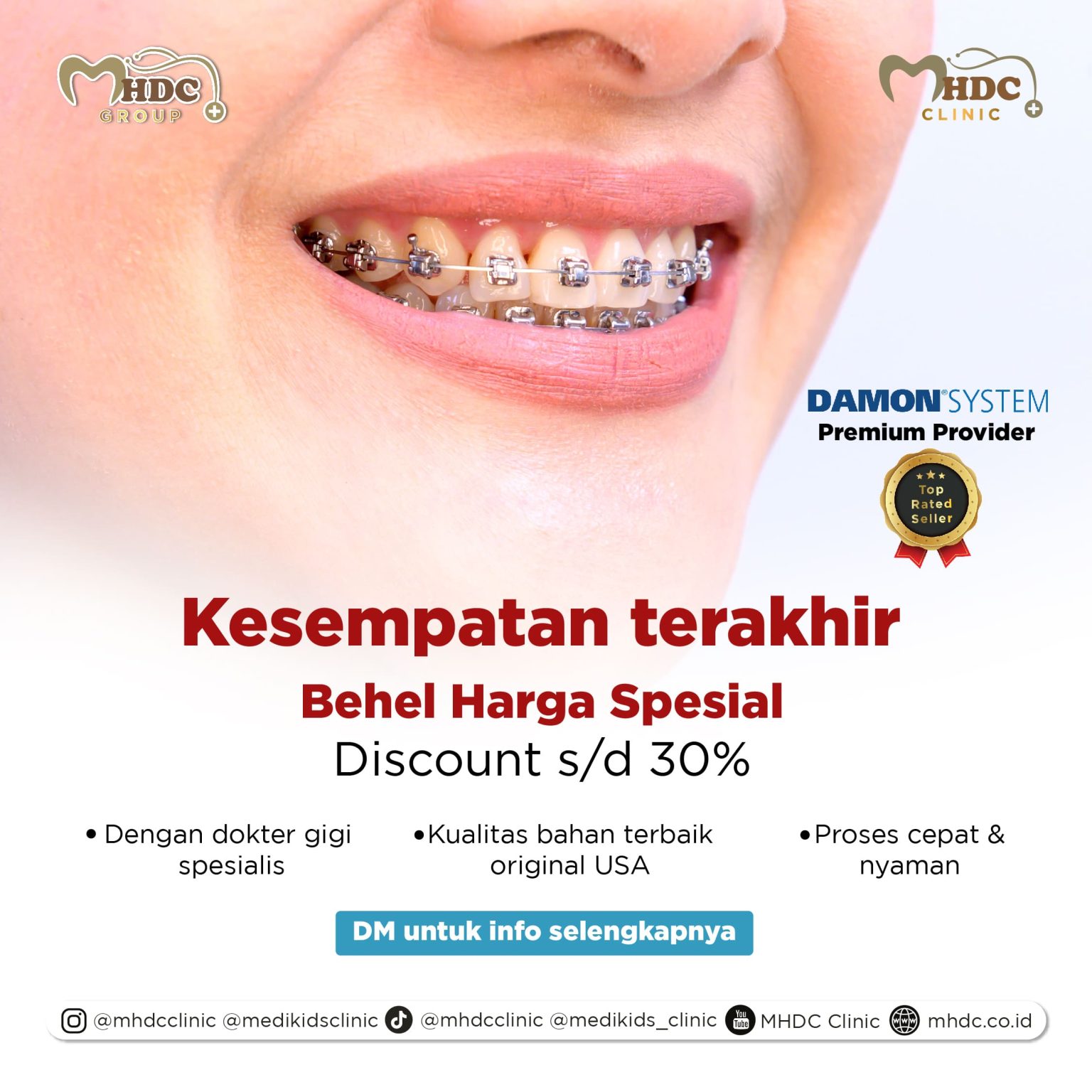 Pilihan dan Kombinasi Warna Karet Behel yang Bagus