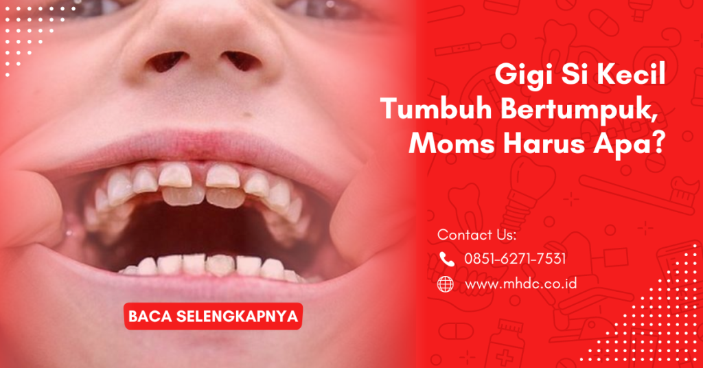 Gigi Si Kecil Tumbuh Bertumpuk, Moms Harus Apa?