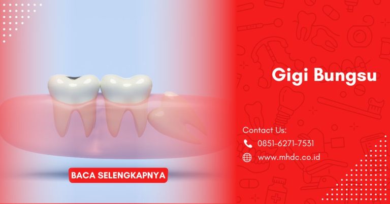 Gigi Bungsu : Pengertian, Gejala dan Cara Mengatasinya!