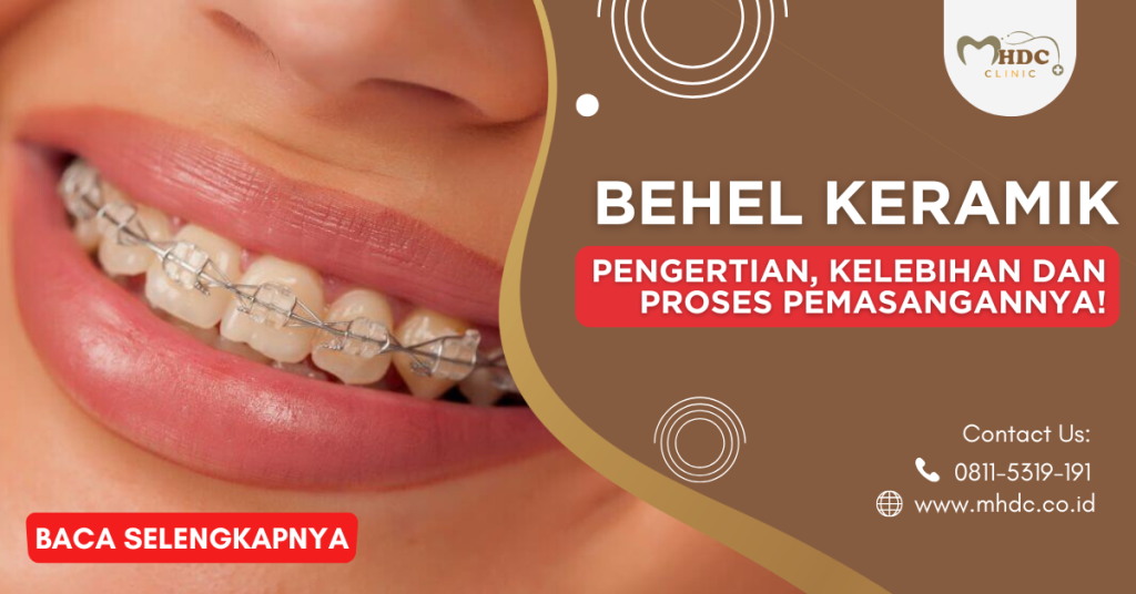 Behel Keramik: Pengertian, Kelebihan dan Biaya Pemasangan