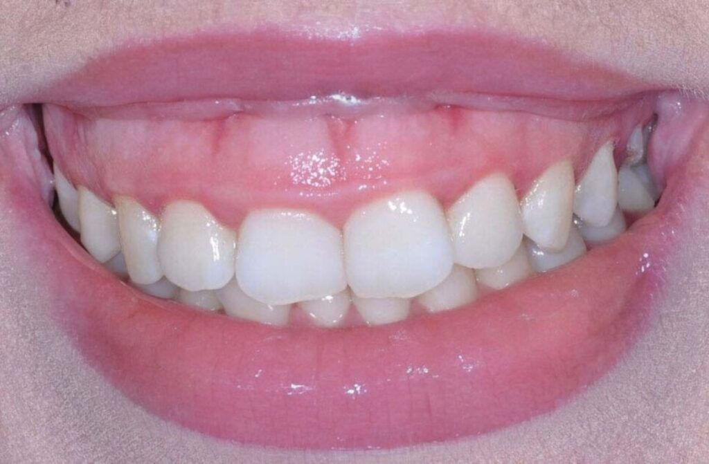 Crown Gigi Adalah: Pengertian, Fungsi, dan Pemasangannya!