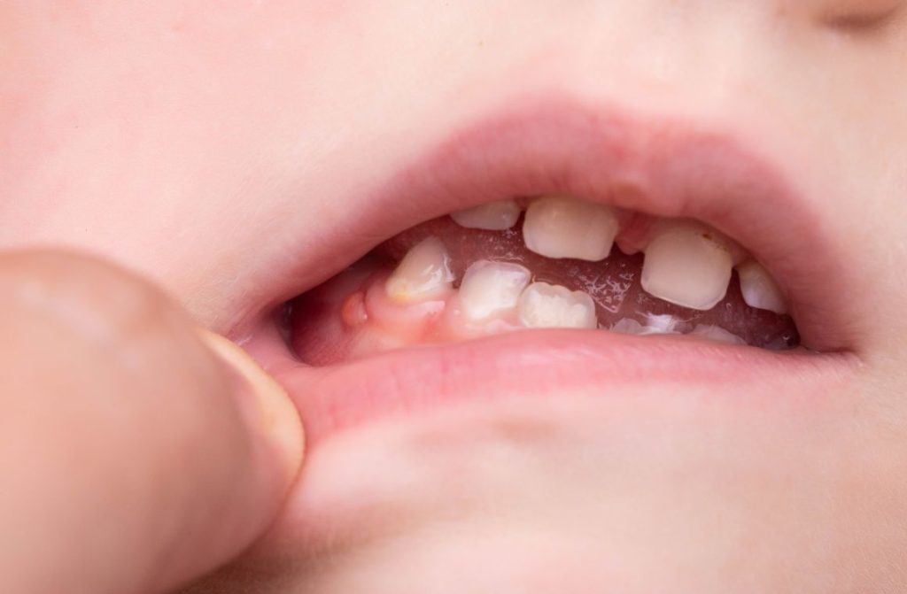 Gusi Bengkak pada Anak: Penyebab, Gejala, Cara Pencegahannya