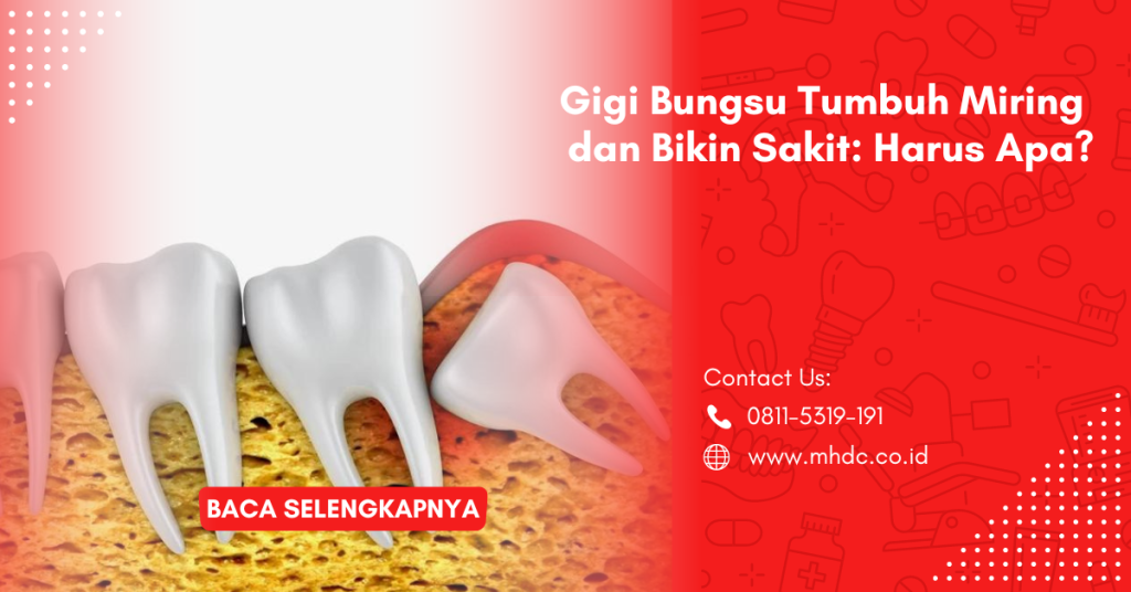 Gigi Bungsu Tumbuh Miring dan Bikin Sakit: Harus Apa?