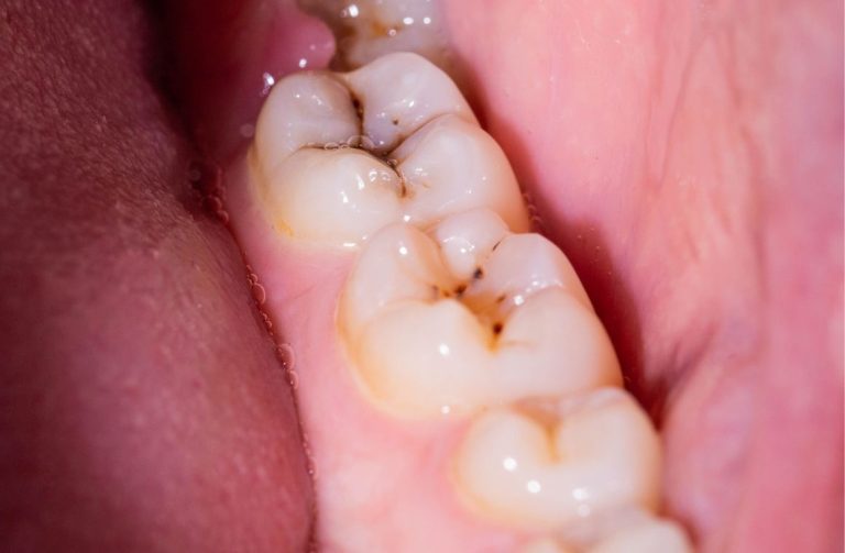 Apa Itu Karies Gigi? Penyebab dan Cara Mencegahnya!