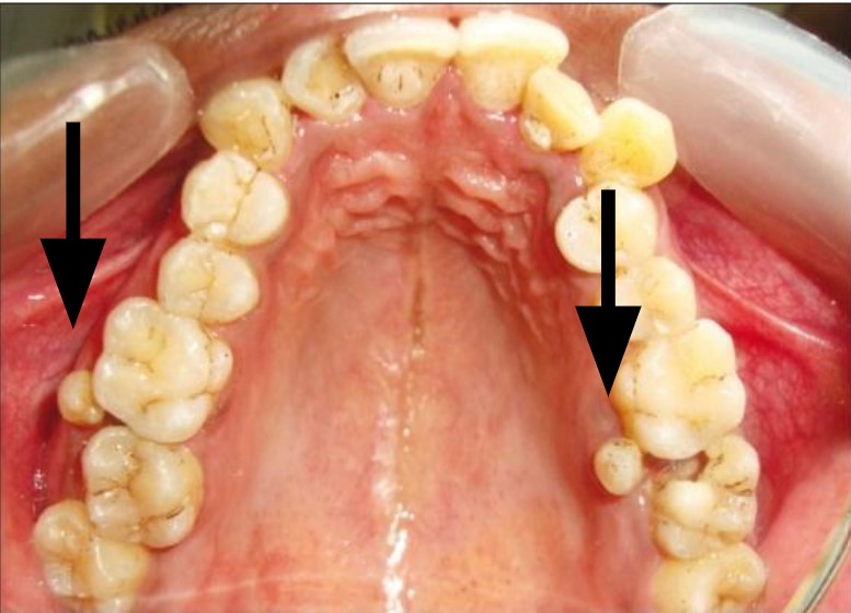 Warna Gigi Anak Berubah? Kenali Kelainan Gigi