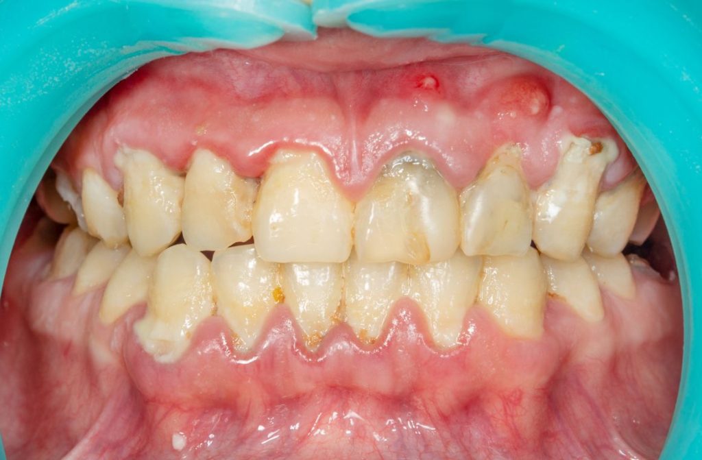 Plak Gigi Adalah: Penyebab, Dampak, dan Cara Mengatasinya!