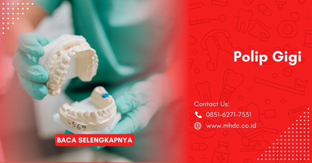 Mengenal Polip Gigi : Penyebab, Jenis dan Cara Mengobatinya