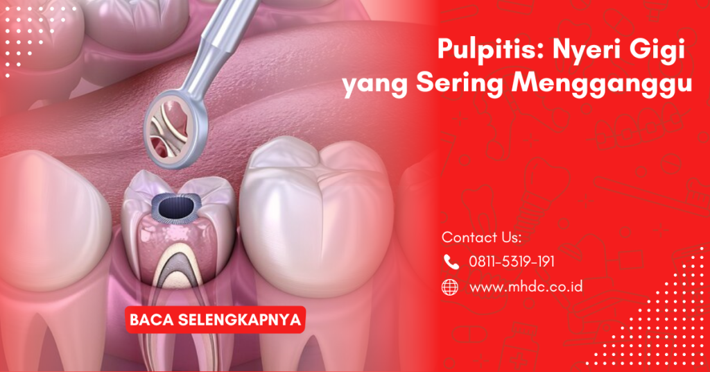 Pulpitis: Nyeri Gigi yang Sering Mengganggu