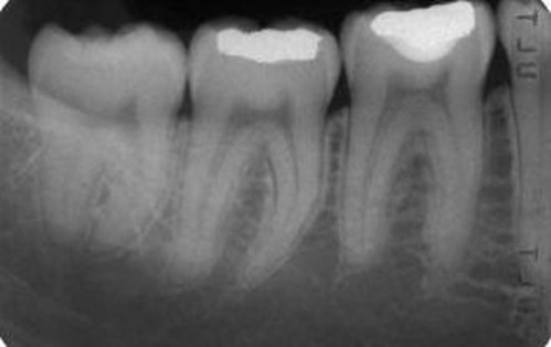 Pentingnya Rontgen Gigi Sebelum Melakukan Pencabutan Gigi – Klinik ...