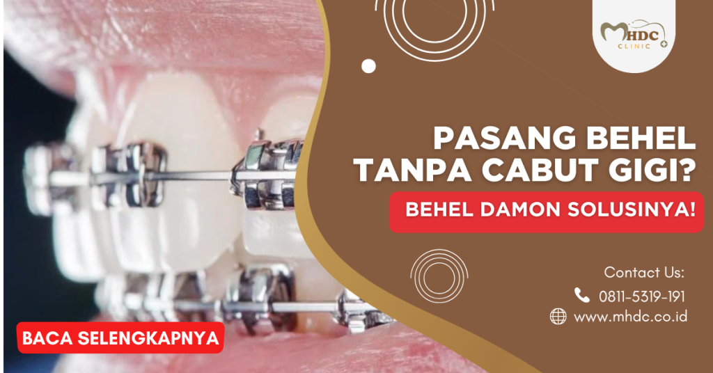 Pasang Behel Tanpa Cabut Gigi? Behel Damon Solusinya!