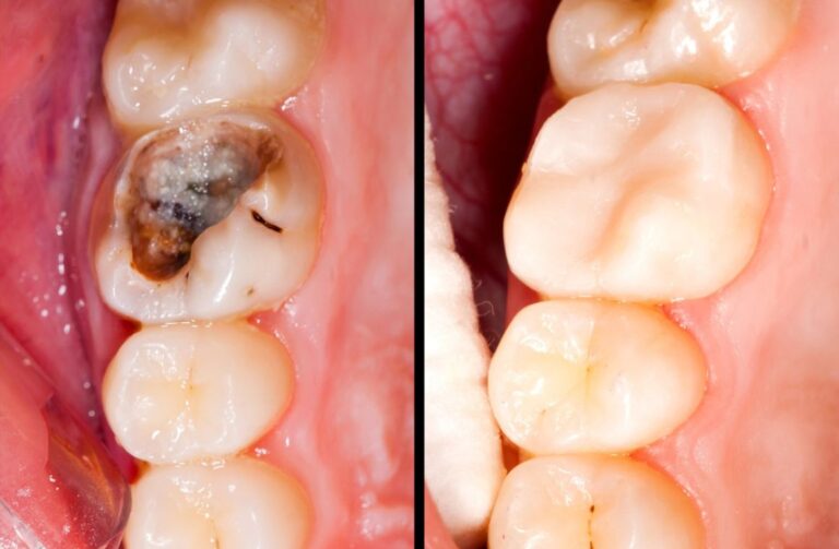 Penambalan Gigi Susu Anak